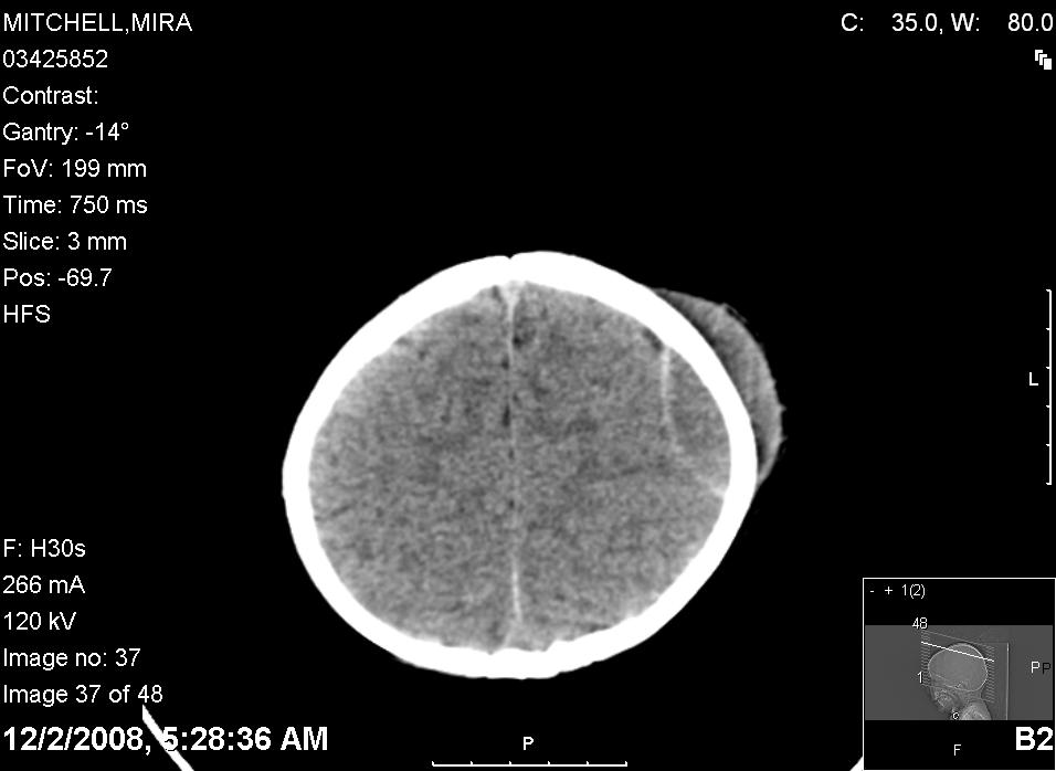 Brain Surgery, or as the hospital calls it: Craniotomy | Mitchell Story!